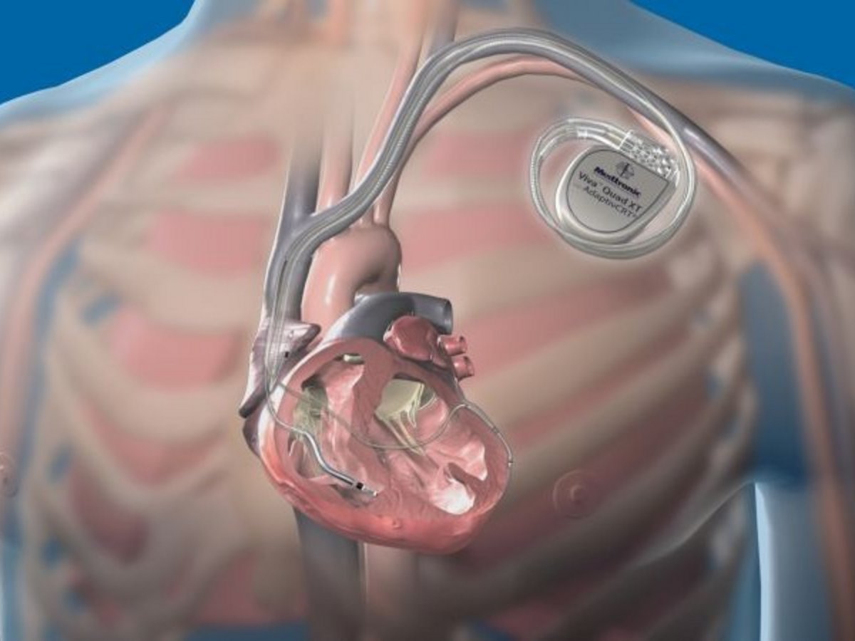 Qué es un marcapasos y para qué sirve: un gran aliado del corazón